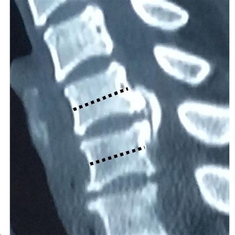 Abbreviations Accf Anterior Corpectomy And Fusion Acdf Anterior