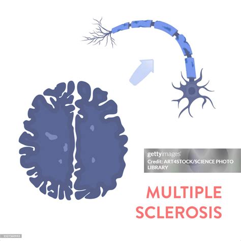 Multiple Sclerosis Conceptual Illustration High Res Vector Graphic