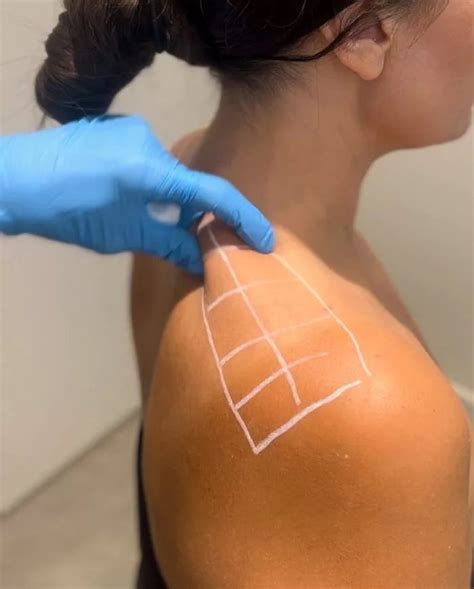 Trap Botox Traptox Santa Rosa And Healdsburg Botox Botox