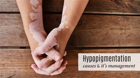 Hypopigmentation What Its Causes Symptoms And Management