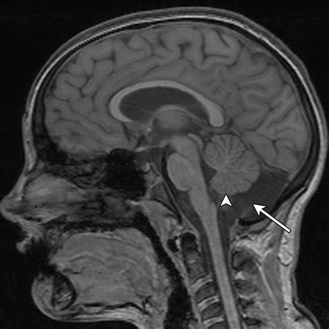 Magna Cisterna Magna Symptoms At Terry Summers Blog