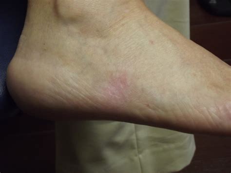 Basal Cell Carcinoma On The Foot After Basal Cell Carcinom Flickr