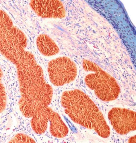 Basal Cell Carcinoma Treatment In Forest Hills Queens Ny Medex Multi Specialty Medical Center