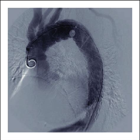 A Patient With Complete Paralysis With Previous Aortic Arch Replacement Download Scientific