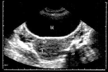 Pelvic Ultrasonography Workup Approach Considerations Imaging Studies