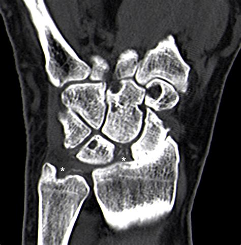 Scapholunate Advanced Collapse A Manifestation Of Calcium Pyrophosphate Deposition Disease