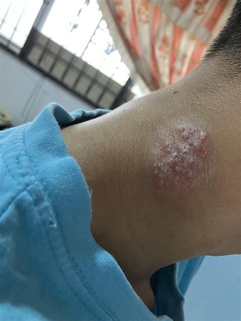 How Bad Is This Shingles Rshingles