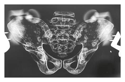 Pelvis With Zero Rotation And Tilt With No Positive Crossover Sign