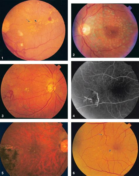 West African Crystalline Maculopathy Ophthalmology
