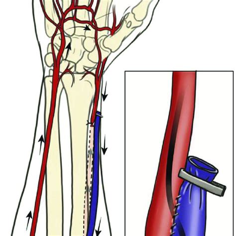 Fig Forearm And Hand Arterial And Venous Anatomy With The Autogenous
