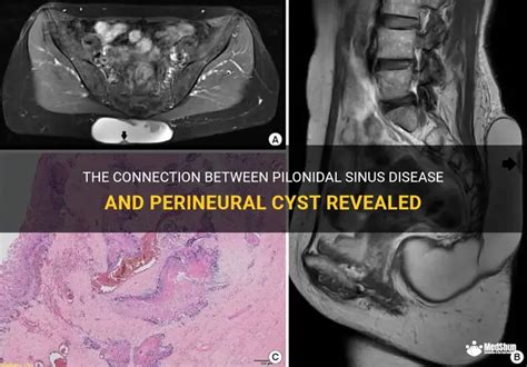 The Connection Between Pilonidal Sinus Disease And Perineural Cyst