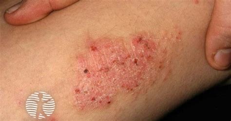 Lichen Simplex Image