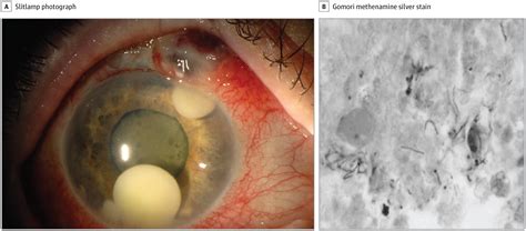 Bleb Associated Exogenous Nocardia Endophthalmitis Infectious