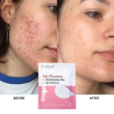 Microneedle Acne Patch Dark Spot And Pimple Care