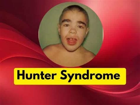 Understanding Hunter Syndrome A Comprehensive Guide To A Rare Genetic