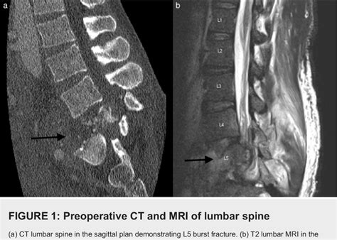 Figure 3 From L5 Fracture Dislocation Secondary To Cold Abscess Treated