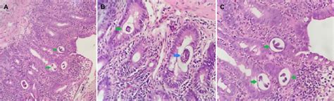 Histological Aspects Of Strongyloidiasis In The Duodenum The Section