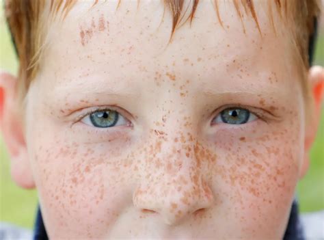 Why Do We Get Freckles Advice From Dermatologist In Alamo Ca Skin