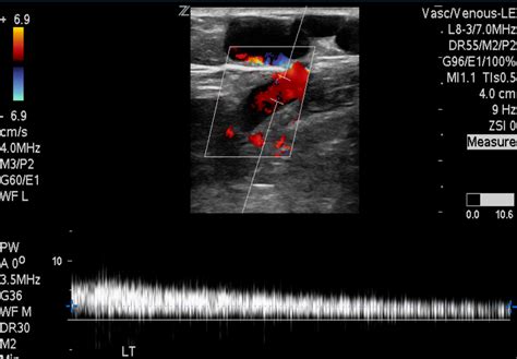 Venous Insufficiency Michael Cumming Md Mba