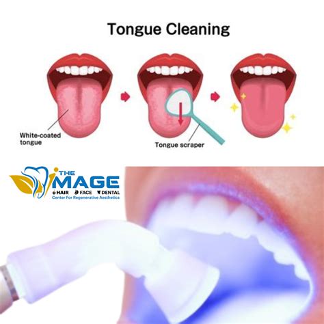 White Tongue Treatment