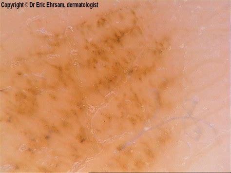 Dermoscopy Fibrillar Pattern