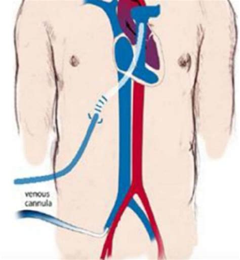Early Liberal Use Of Ecmo Femoral Veinpulmonary Artery As Temporary