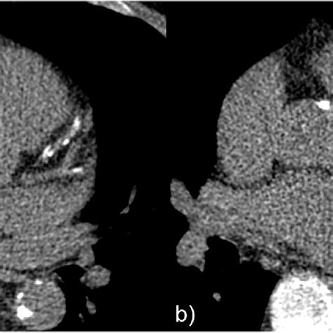 Example Of Similar Agatston Score Equivalents Derived From Standard Ccs Download Scientific