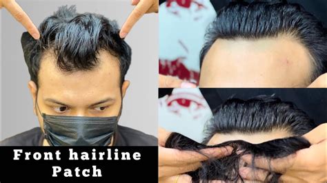 Frontline Hair Patch For Men In Delhi Amazing Hair Replacement