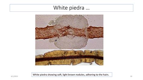 Superficial Mycoses Pptx