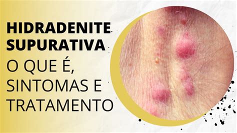 Hidradenite Supurativa Axilar