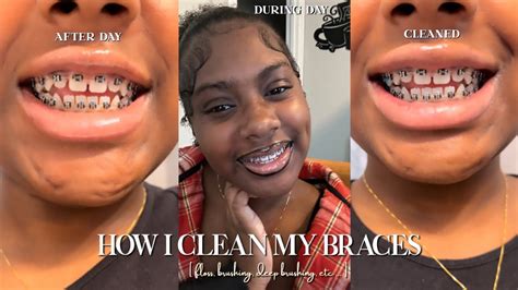 Vlog How I Clean My Braces Night Routine Brushing Deep Cleaning