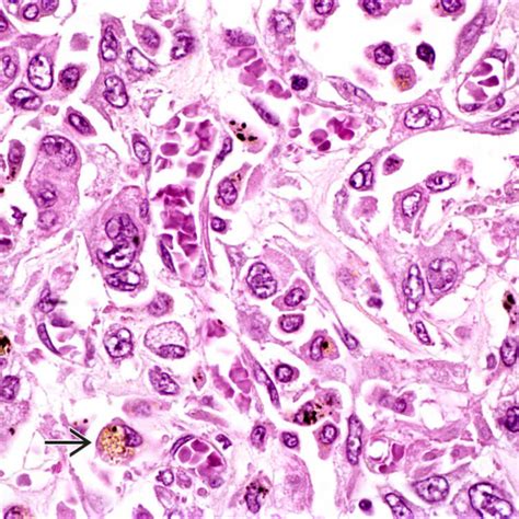 Angiosarcoma Basicmedical Key