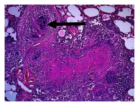 Unusual Manifestation Of Extrapulmonary Tuberculosis Pmc