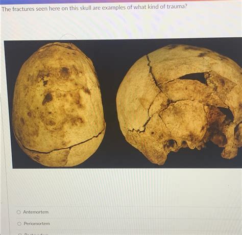 Solved The Fractures Seen Here On This Skull Are Examples Of