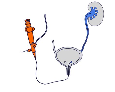 Ureteropyeloscopy Brisbane Urology Clinic
