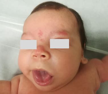 Macroglossia The Importance Of Genetic Testing For Prognosis
