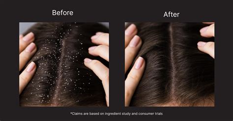 Can Shampoo Give You Dandruff Why Your Shower Routine Might Be