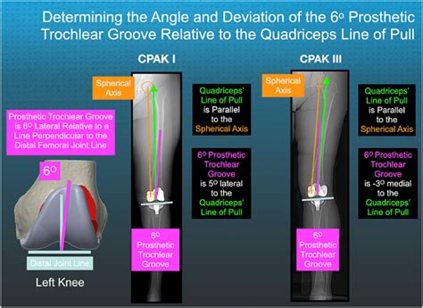 Medial Deviation Of A 6° Prosthetic Trochlear Groove After