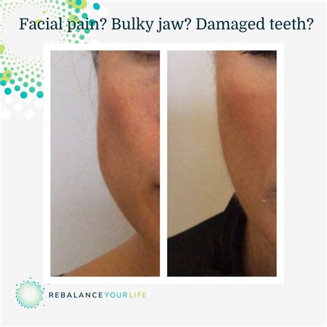 Rebalance Did You Know That Muscle Relaxing Injections Can Treat