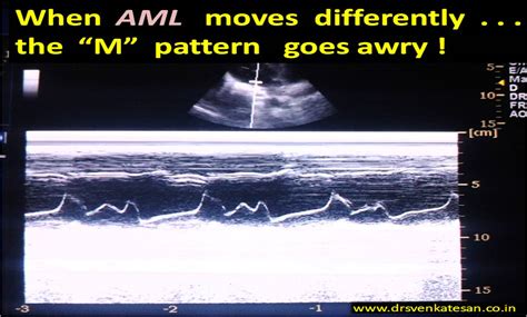Trifid M Mode Echo Of Aml Dr S Venkatesan Md