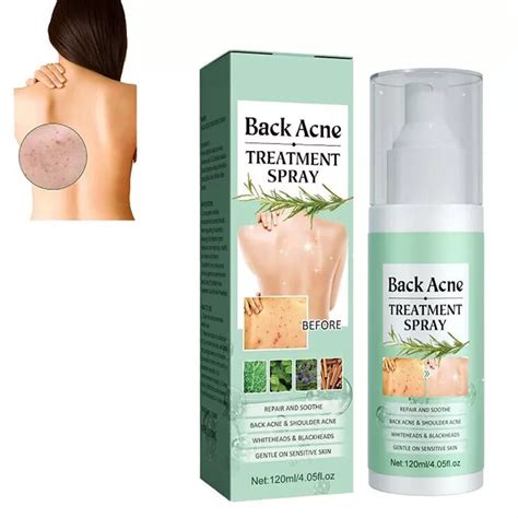 Back Acne Treatment