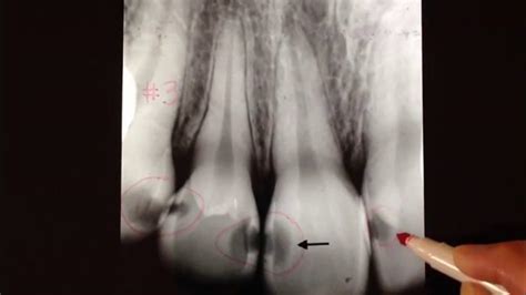 Radiographic Interpretation Of Dental Caries Classification Acj Youtube