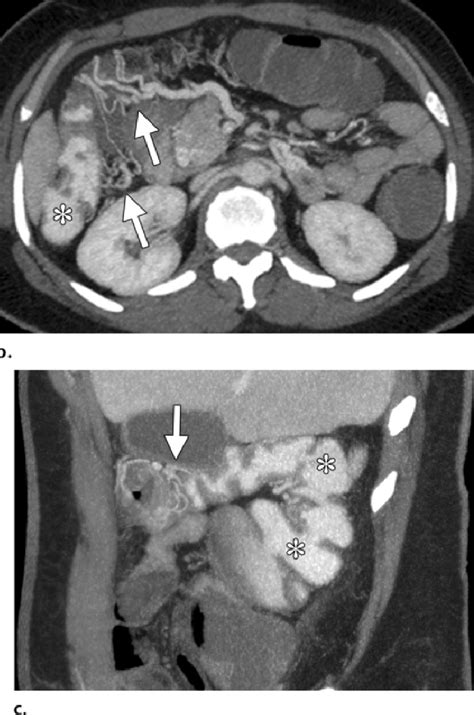 Right Colonic Angiodysplasia Causing Severe Lower Gastrointestinal