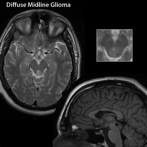 Clinical Pathology Glossary Diffuse Midline Glioma Ditki Medical