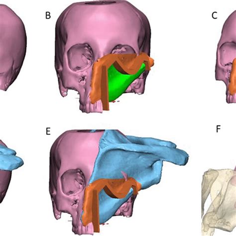A D Different Views Of 3d Virtually Designed Maxillary Resection Download Scientific Diagram