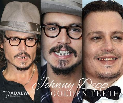 Johnny Depp Teeth New Rotting Before And After Teeth Journey