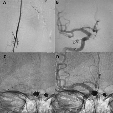 A 32 Year Old Female With Previously Coiled Bilateral Ophthalmic