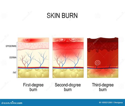 Skin Burn Injury Treatment First Aid For Burn Wound Vector