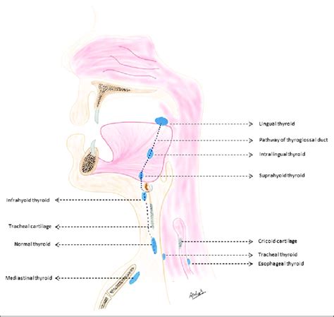 Ectopic Thyroid Endocrinesurgerynetau