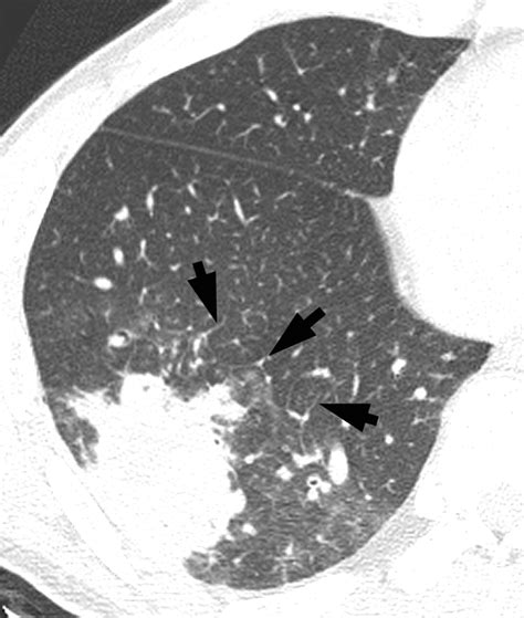 Thoracic Actinomycosis Ct Features With Histopathologic Correlation Ajr